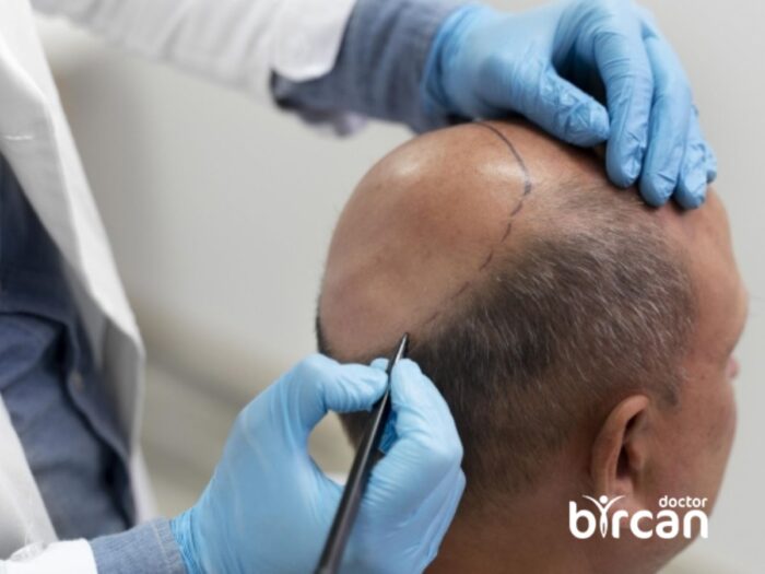 DHI Technique • DHI Hair Transplant Method
