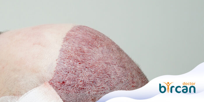 What is the Difference Between DHI Technique and FUE Technique? » Dr ...