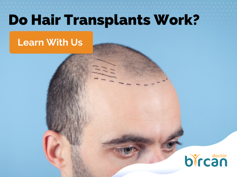 Do Hair Transplants Work? » Dr. Gökhan Bircan